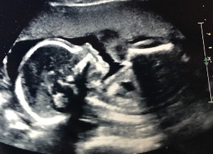 Pregnancy Anomaly Ultrasound Scan | Best & Most detailed scan in Pune